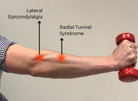 Injury Update: Tennis Elbow - Glebe Physio